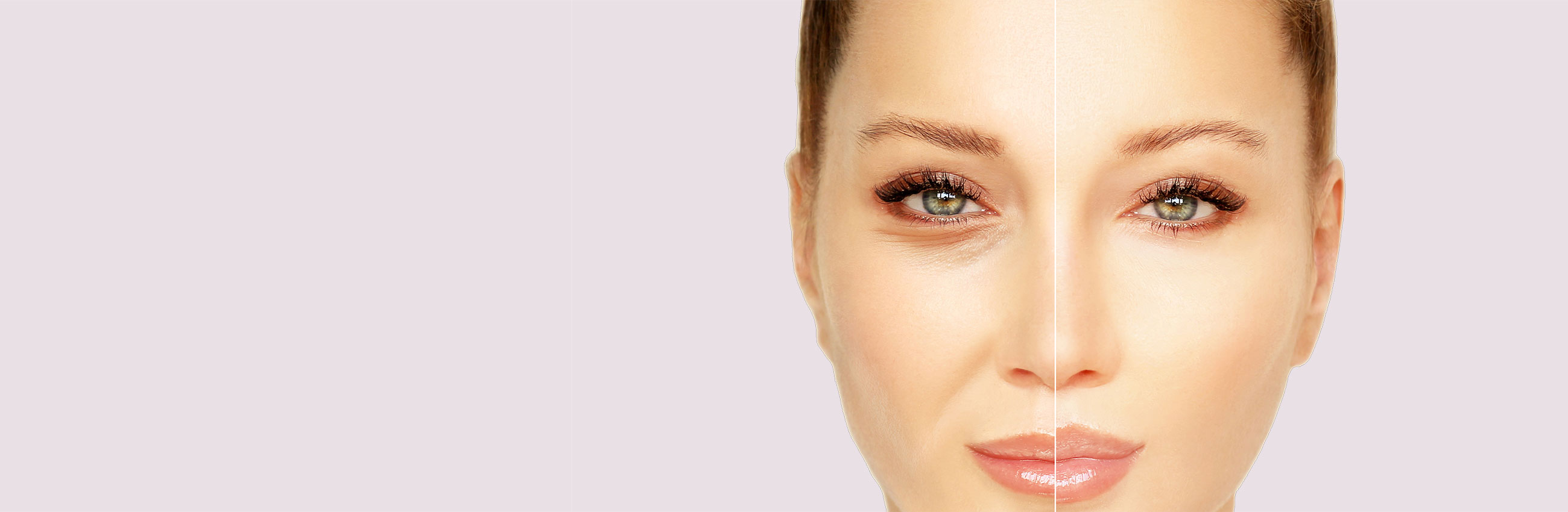 Photos avant/après injection d’Acide Hyaluronique à Cannes | Dr PECHA