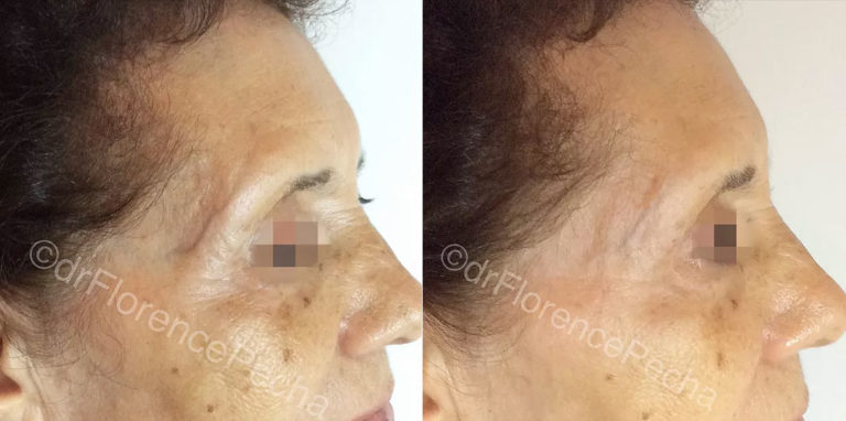 Le traitement des tempes creuses | Dr PECHA, Médecine Esthétique à Cannes