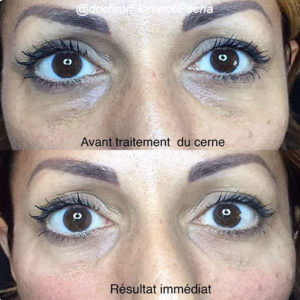 Photos avant/après injection d’Acide Hyaluronique à Cannes | Dr PECHA