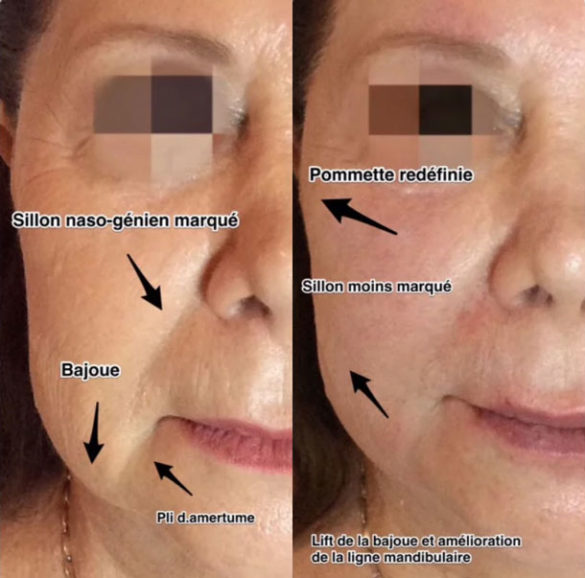 Photos avant/après injection d’Acide Hyaluronique à Cannes | Dr PECHA