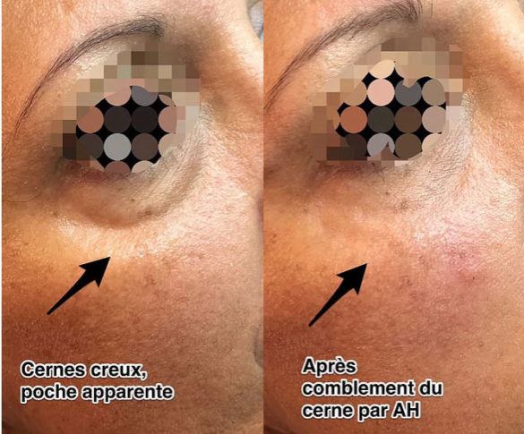 Photos avant/après injection d’Acide Hyaluronique à Cannes | Dr PECHA